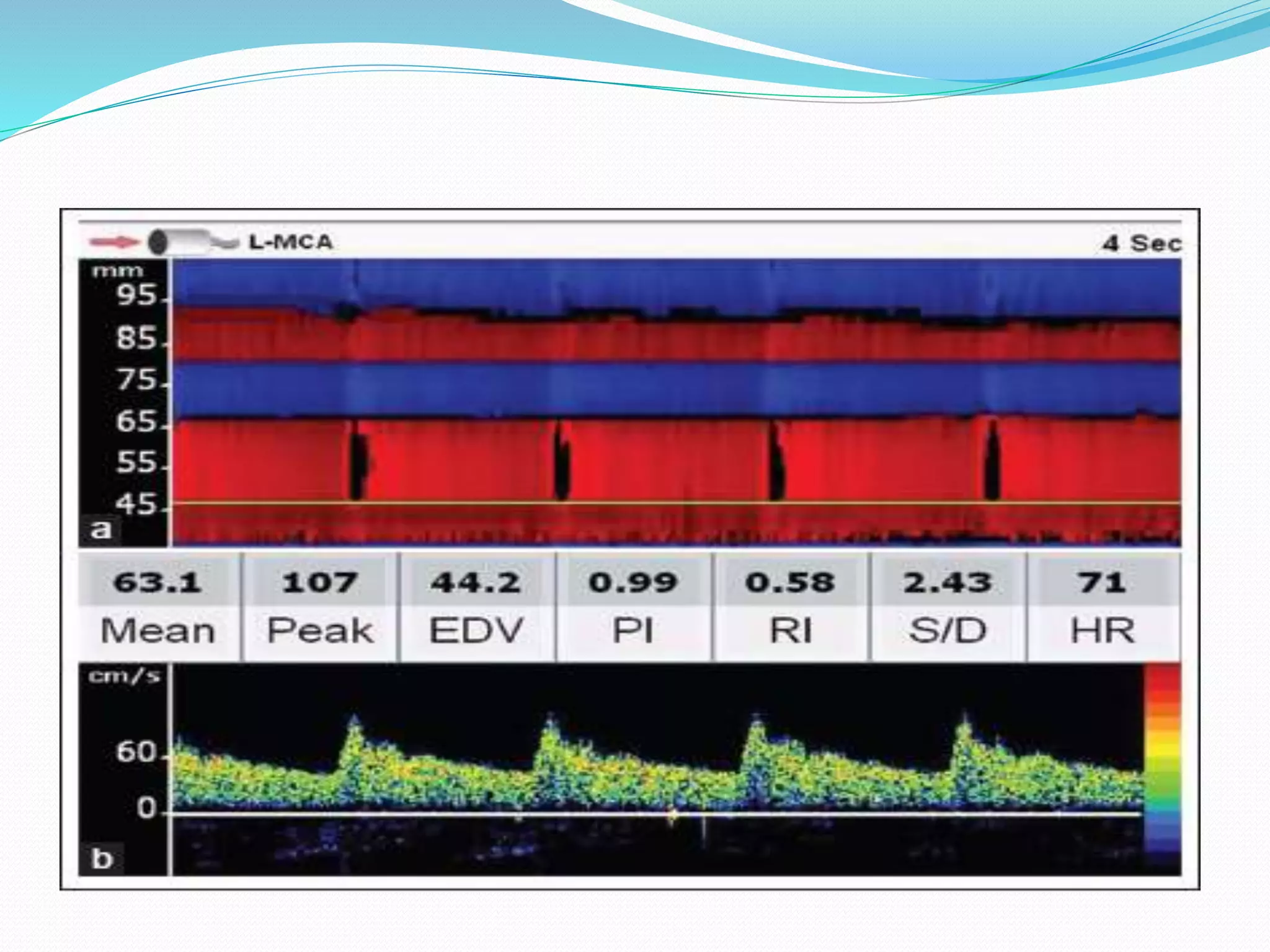 Transcranial doppler | PPTX