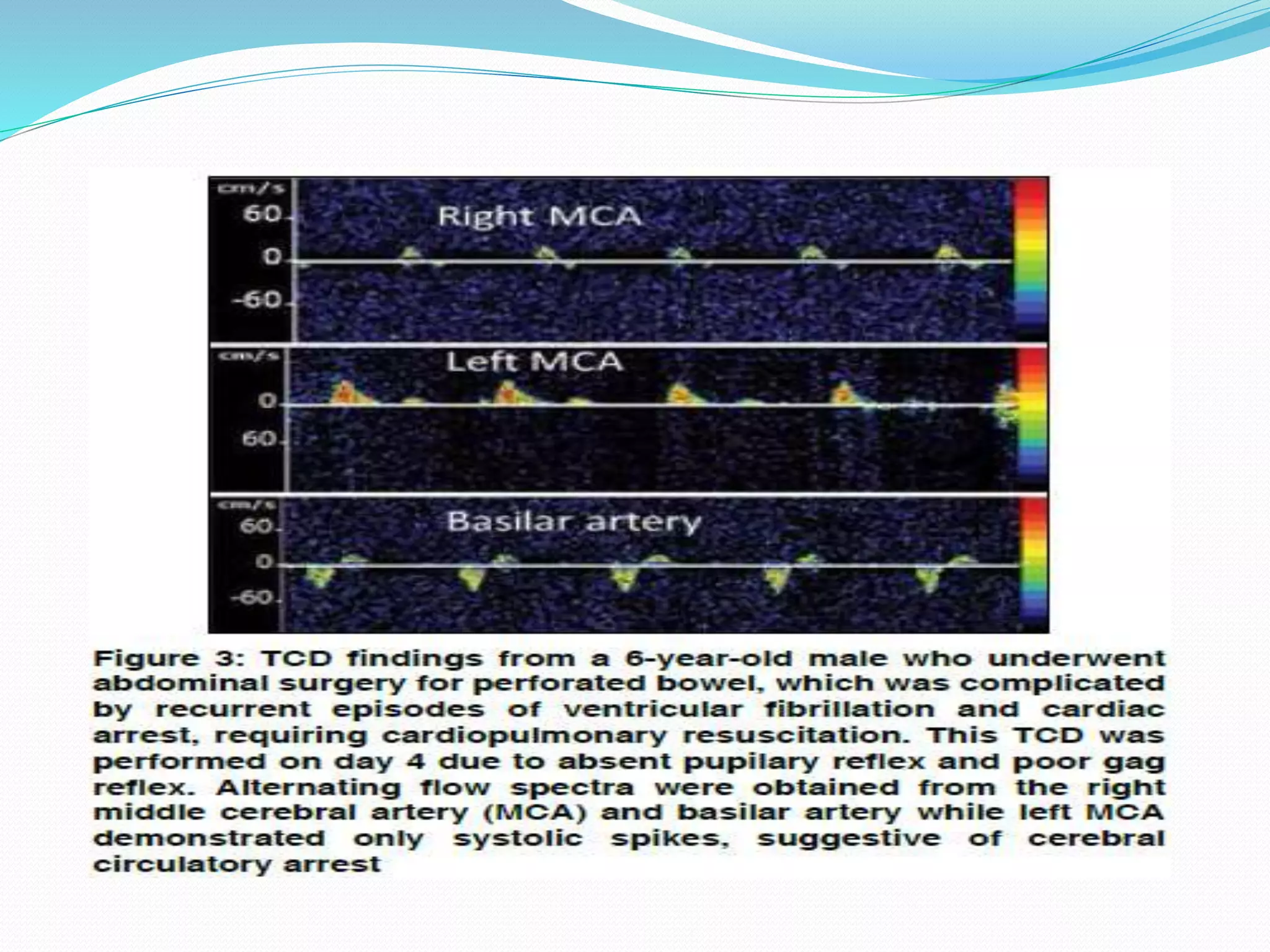 Transcranial doppler | PPTX