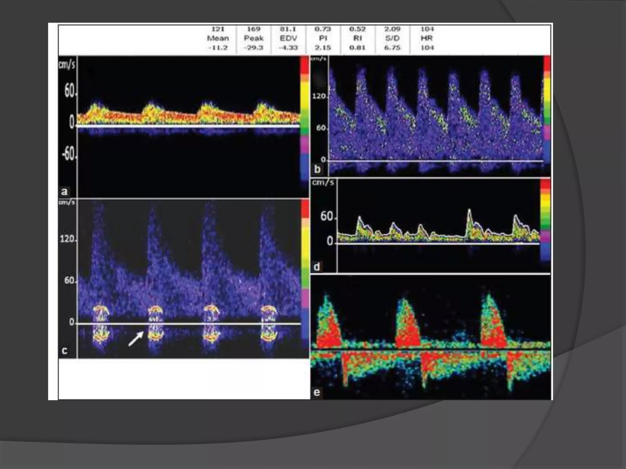TRANSCRANIAL DOPPLER (1).pptx