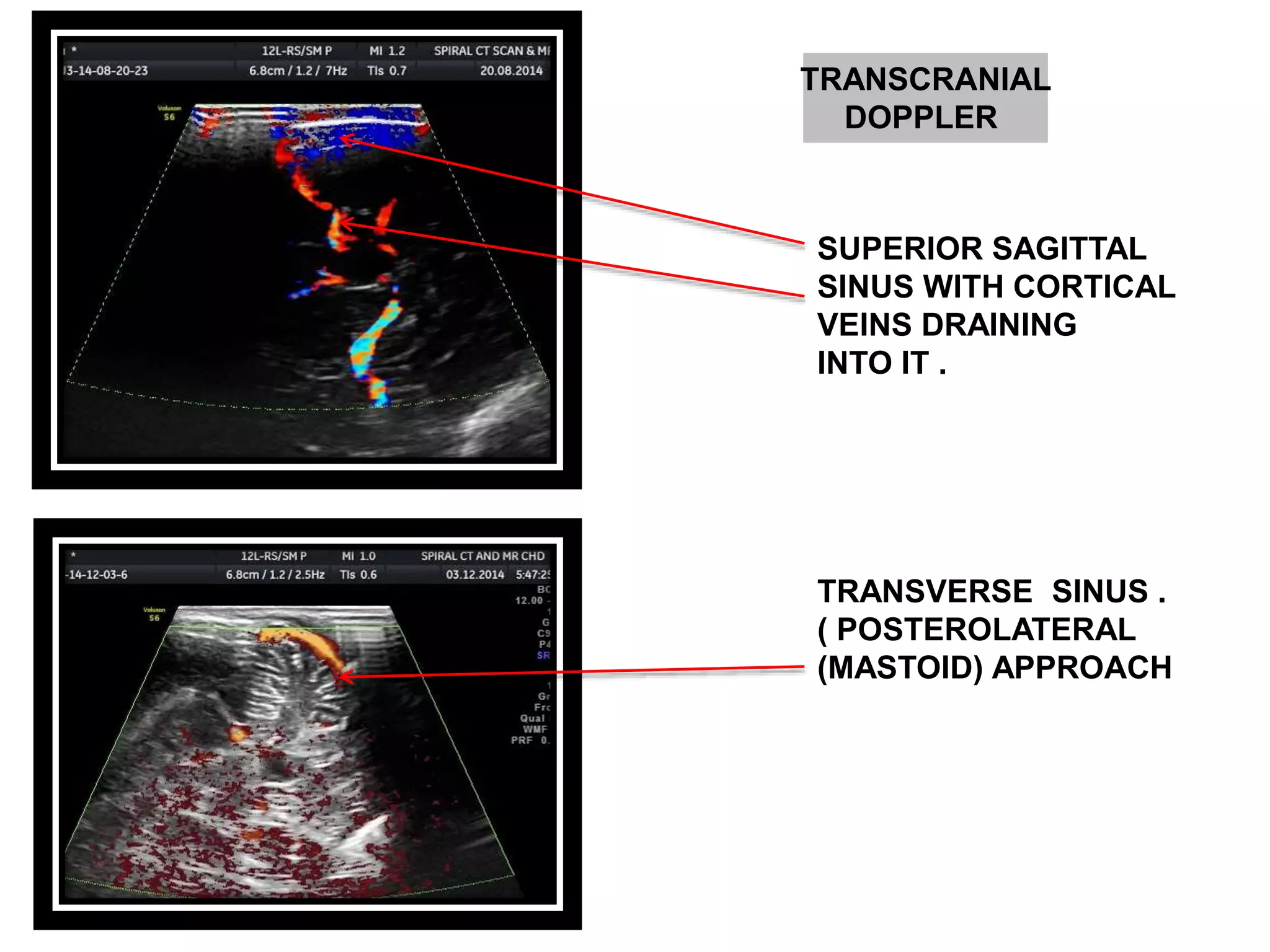 Transcranial doppler advanced usg lounge | PPTX