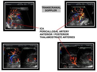 Transcranial doppler advanced usg lounge | PPTX