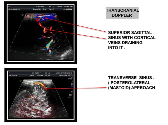 Transcranial doppler advanced usg lounge | PPT