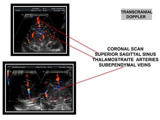 Transcranial doppler advanced usg lounge | PPTX