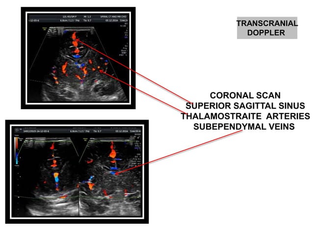 Transcranial doppler advanced usg lounge | PPT