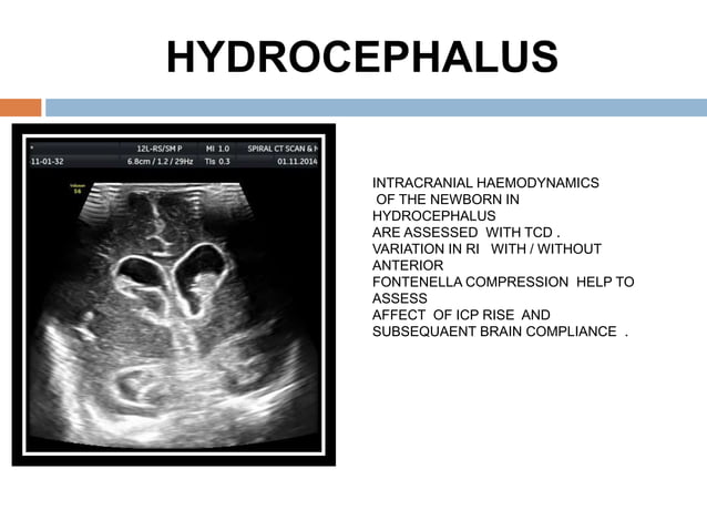Transcranial doppler advanced usg lounge | PPT