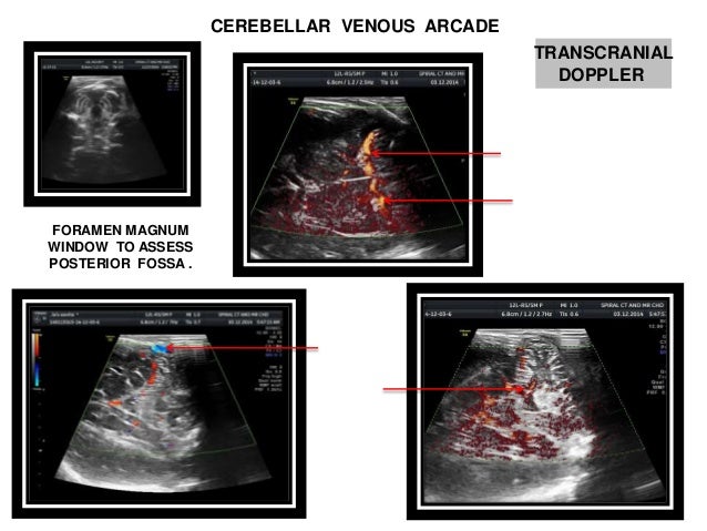 Transcranial doppler advanced usg lounge