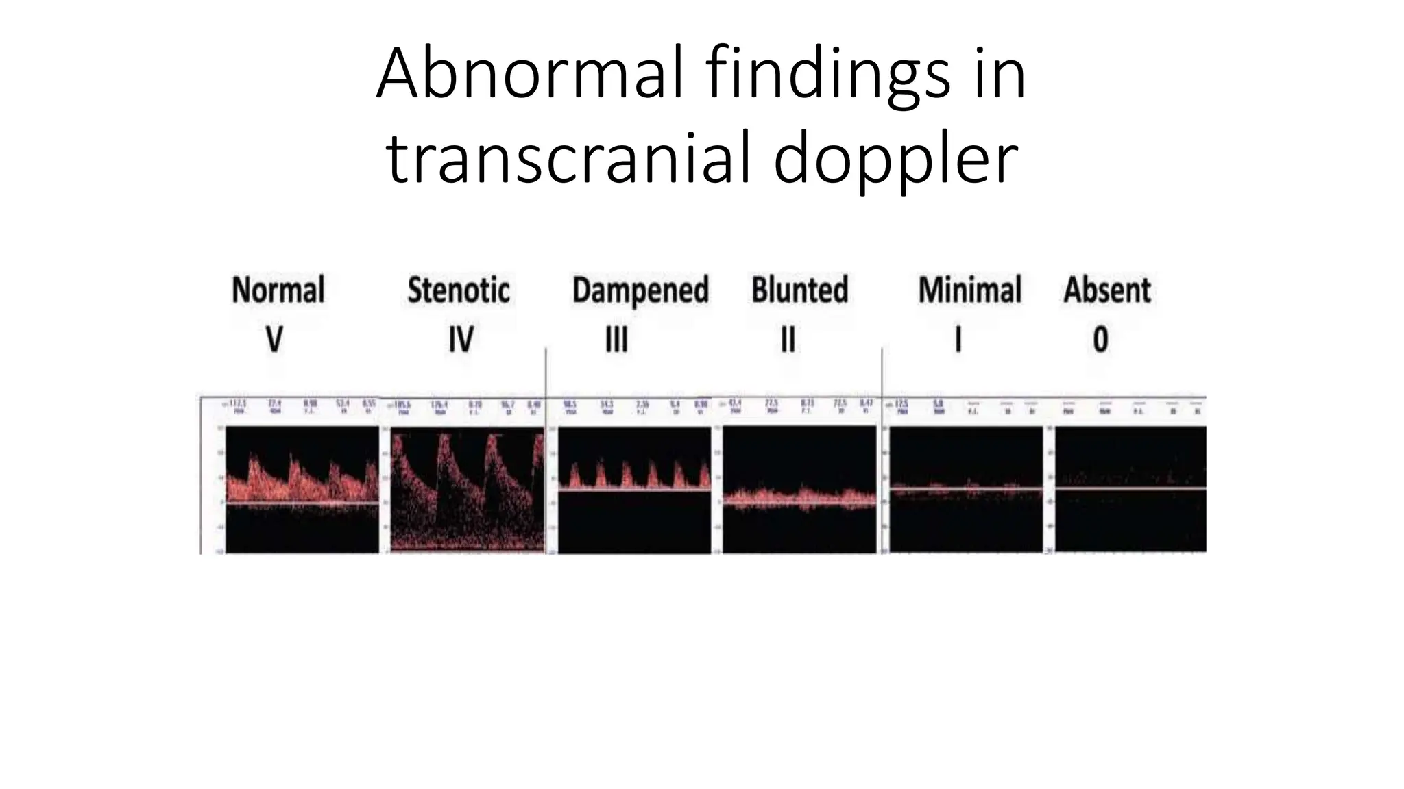 Transcranial doppler ultrasound, principles and procuderes | PPTX