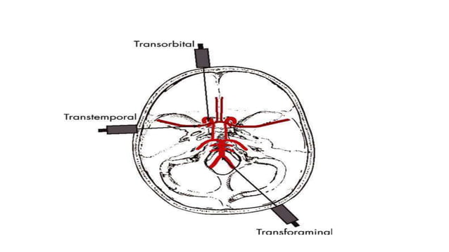Transcranial doppler ultrasound, principles and procuderes | PPTX ...