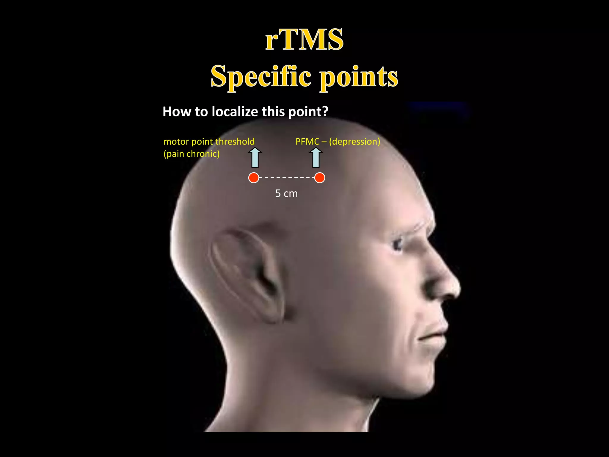 Transcranial Magnetic Stimulation ( TMS) for Chronic Pain | PPTX