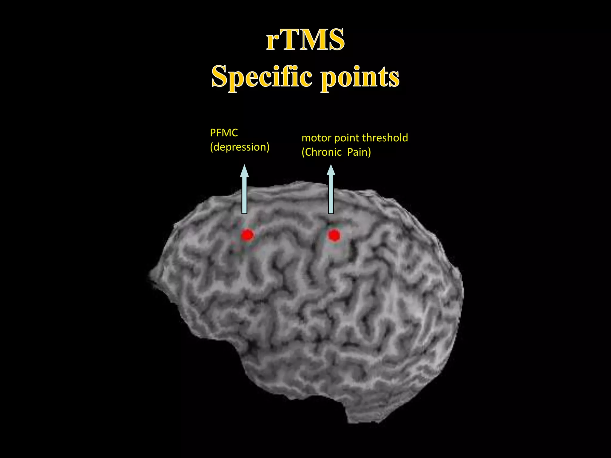 Transcranial Magnetic Stimulation ( TMS) for Chronic Pain | PPTX
