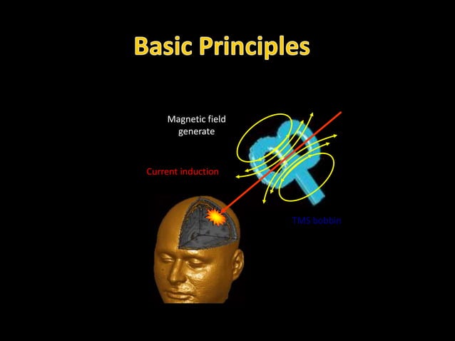 Transcranial Magnetic Stimulation ( TMS) for Chronic Pain | PPTX ...