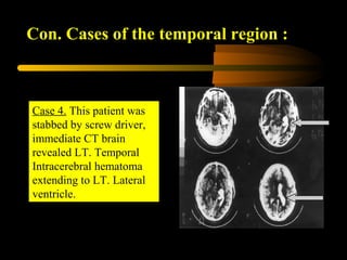 Transcranial stab wounds morbidity and medicolegal awareness. | PPT ...