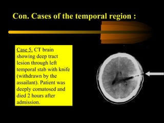 Transcranial stab wounds morbidity and medicolegal awareness. | PPT ...