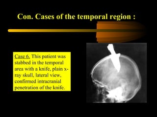 Transcranial stab wounds morbidity and medicolegal awareness. | PPT ...