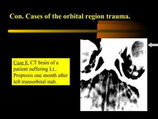 Transcranial stab wounds morbidity and medicolegal awareness. | PPT ...