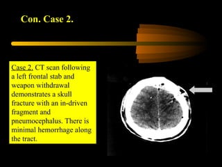 Transcranial stab wounds morbidity and medicolegal awareness. | PPT ...