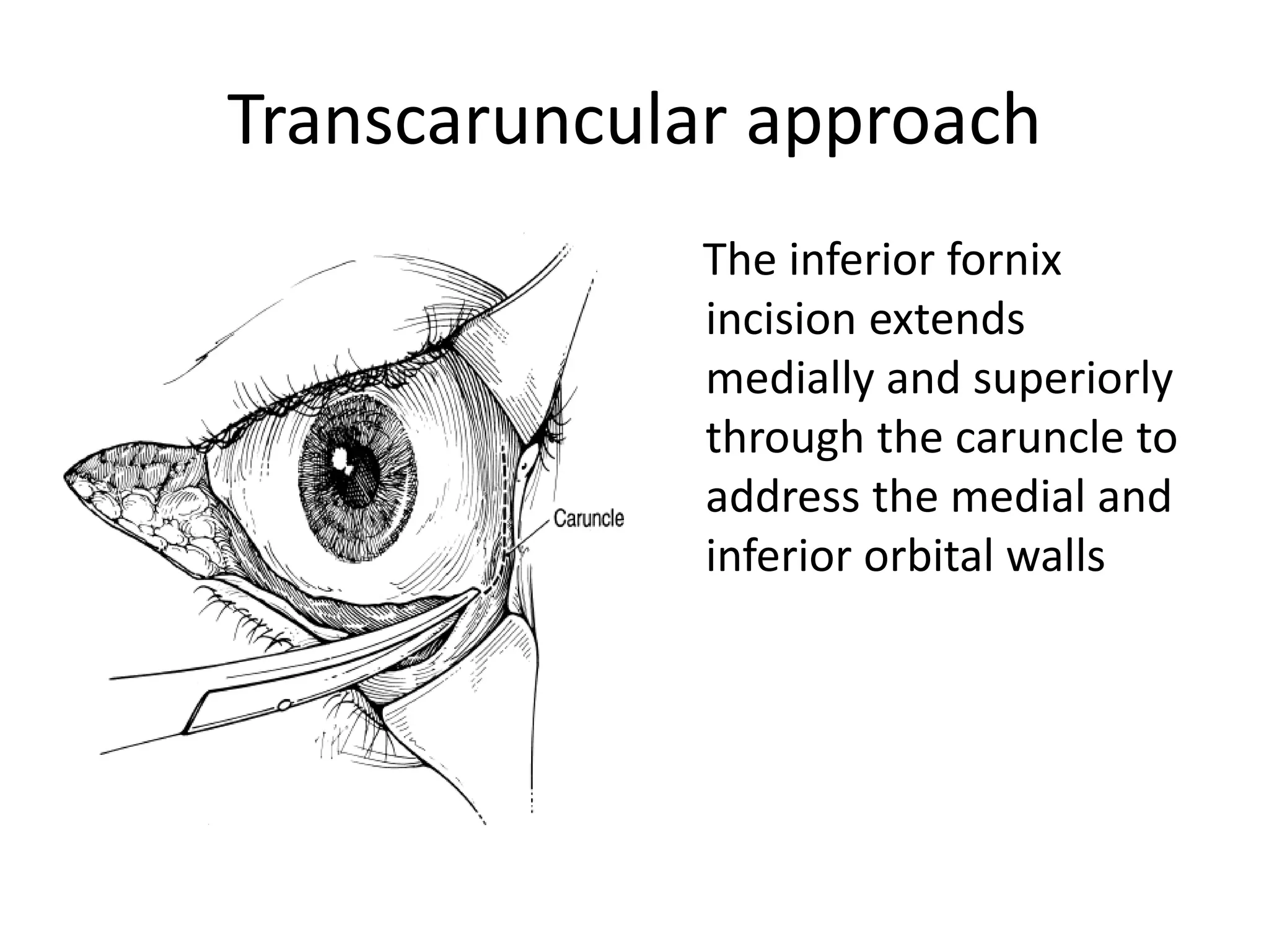 Transcuruncular approach | PPTX
