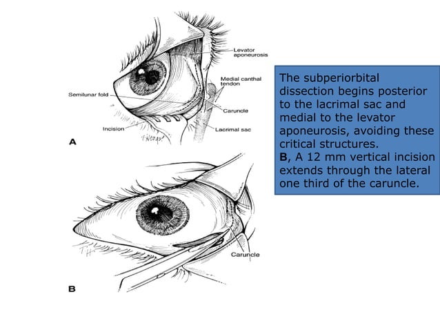 Transcuruncular approach | PPT