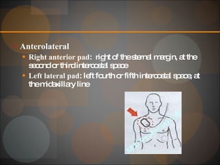 Transcutaneous Pacing | PPT