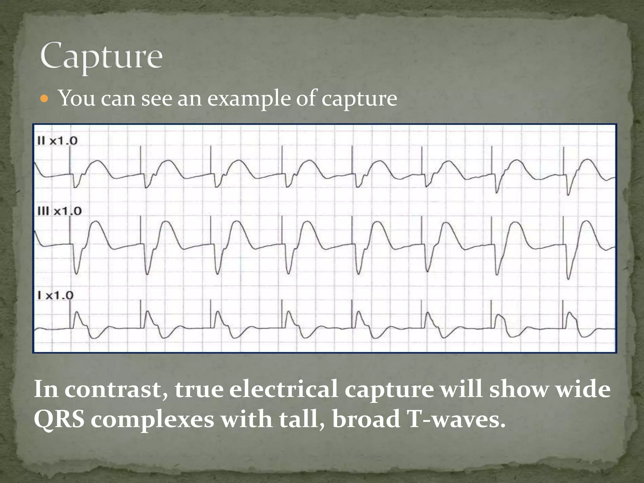 Transcutaneous pacing | PPTX