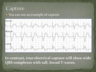 Transcutaneous pacing | PPTX