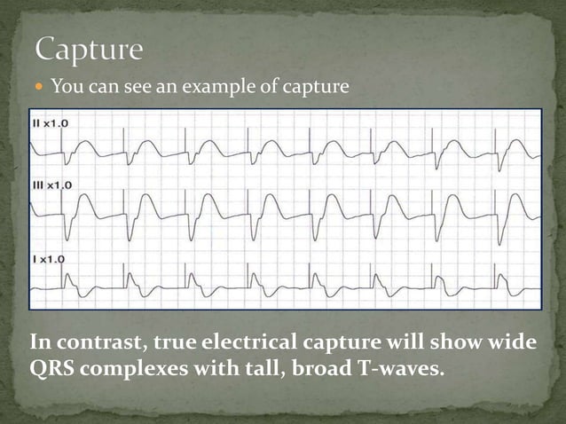 Transcutaneous pacing | PPTX | Heart and Cardiovascular Diseases ...