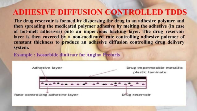 Transdermal drug delivery system (TDDS) it's formulation and evaluation ...