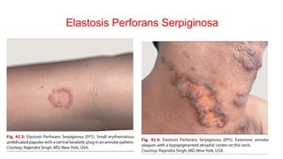 HISTOPATHOLOGY OF TRANSEPIDERMAL ELIMINATION.pptx