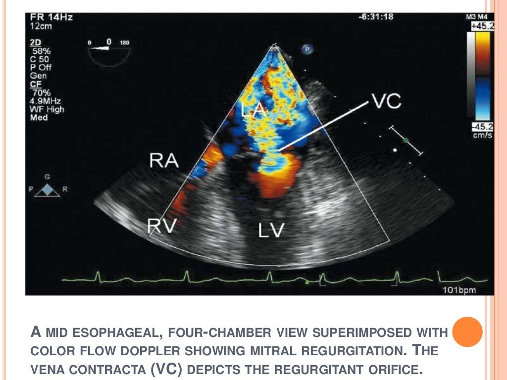 Transesophageal echocardiography