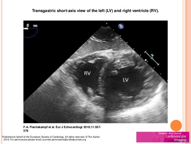 Transesophageal echocardiography