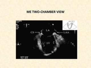 Transesophageal echocardiography | PPSX