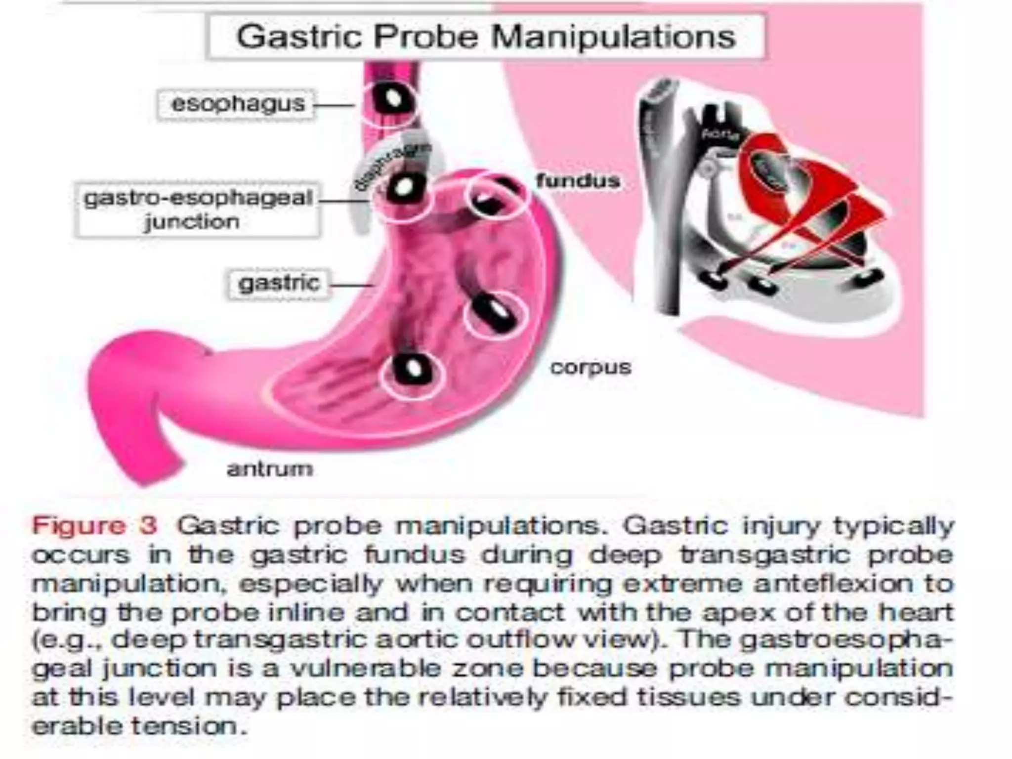 Transesophageal echocardiography(TEE) | PPTX
