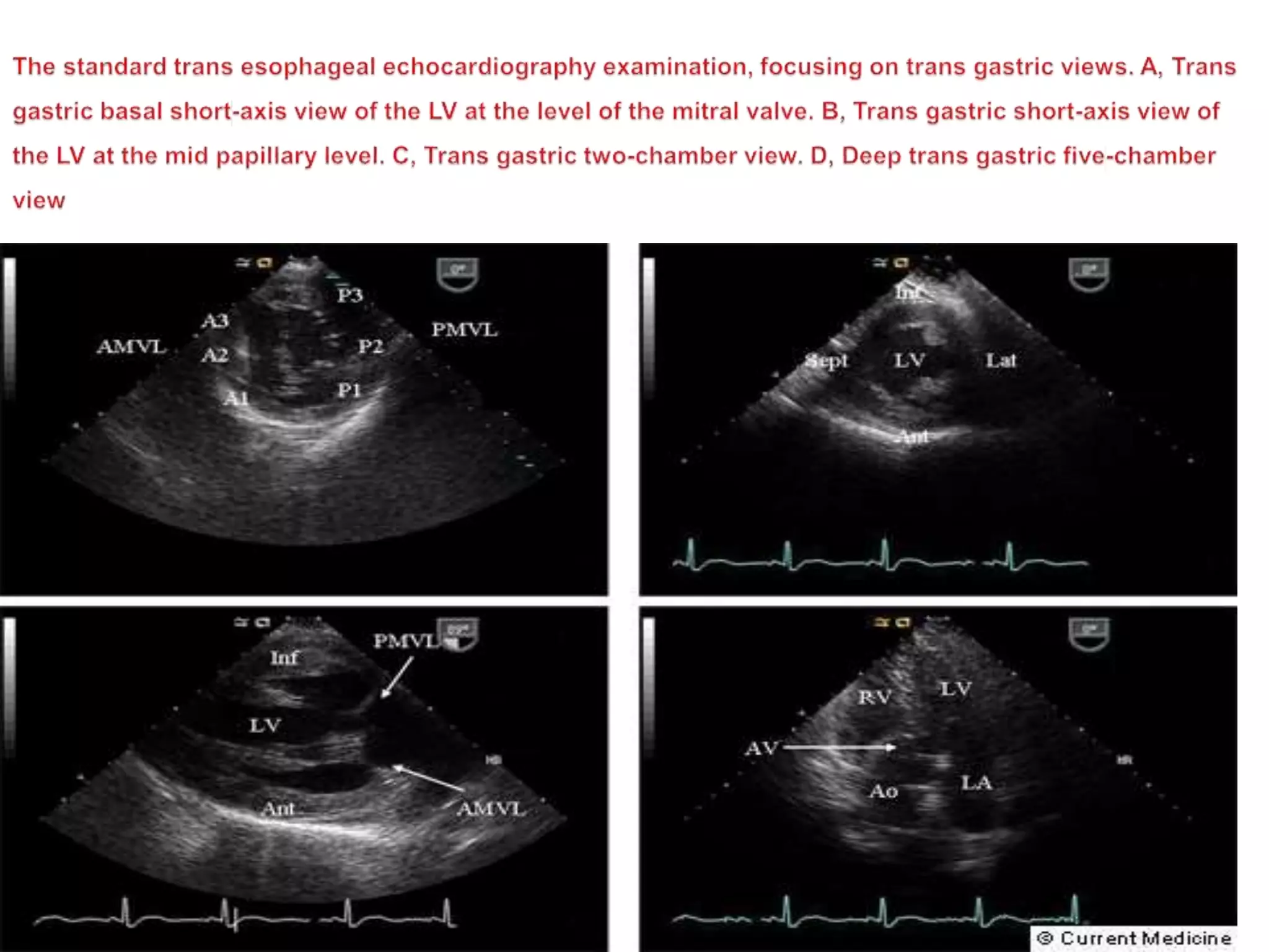 Transesophageal echocardiography(TEE) | PPTX