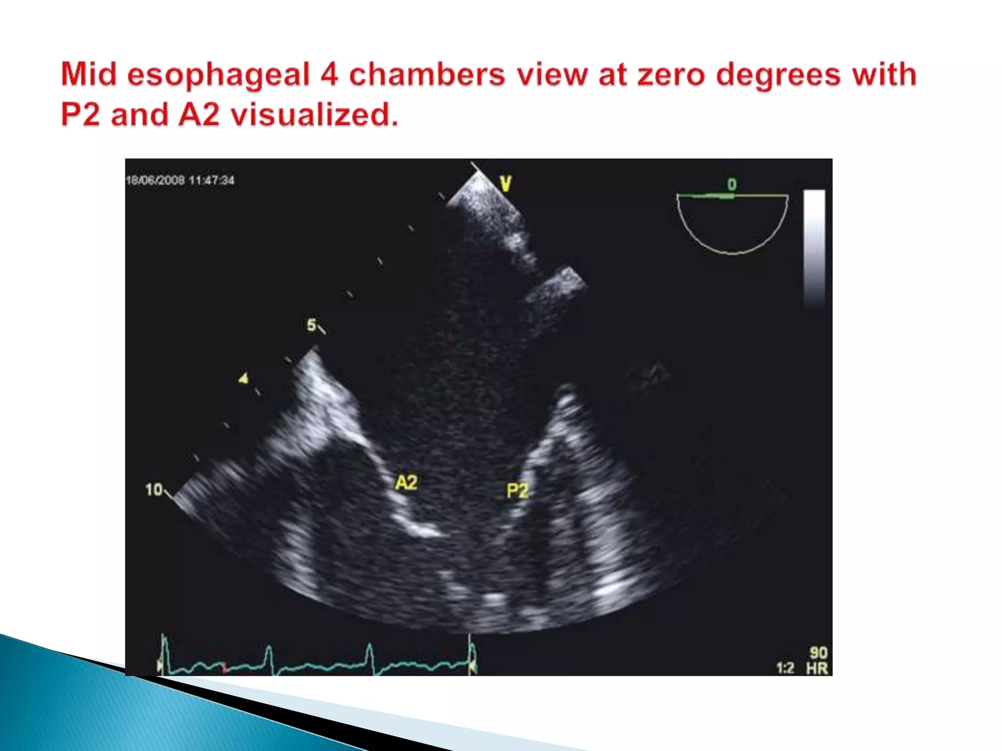 Transesophageal echocardiography(TEE) | PPTX