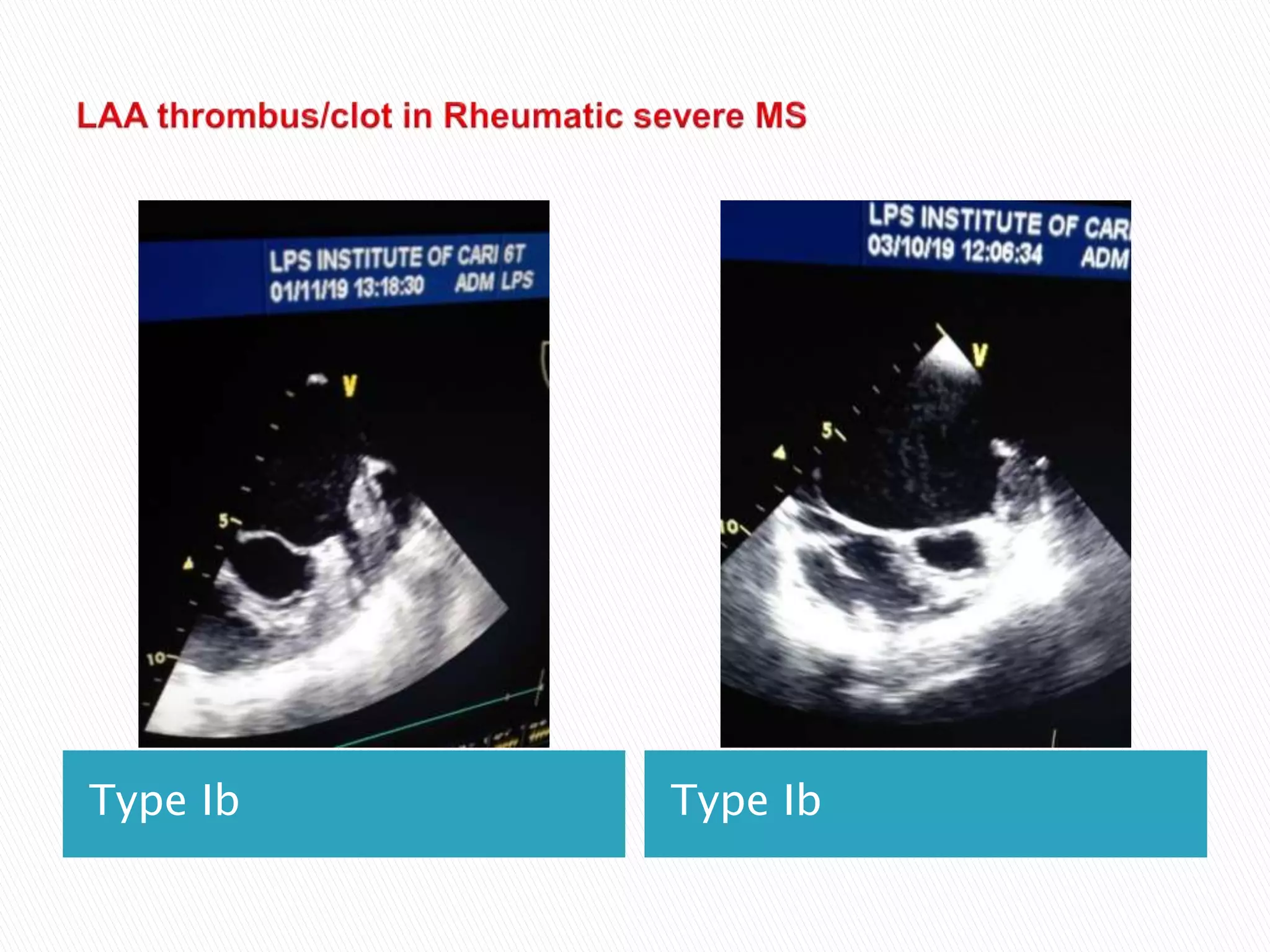 Transesophageal echocardiography(TEE) | PPTX