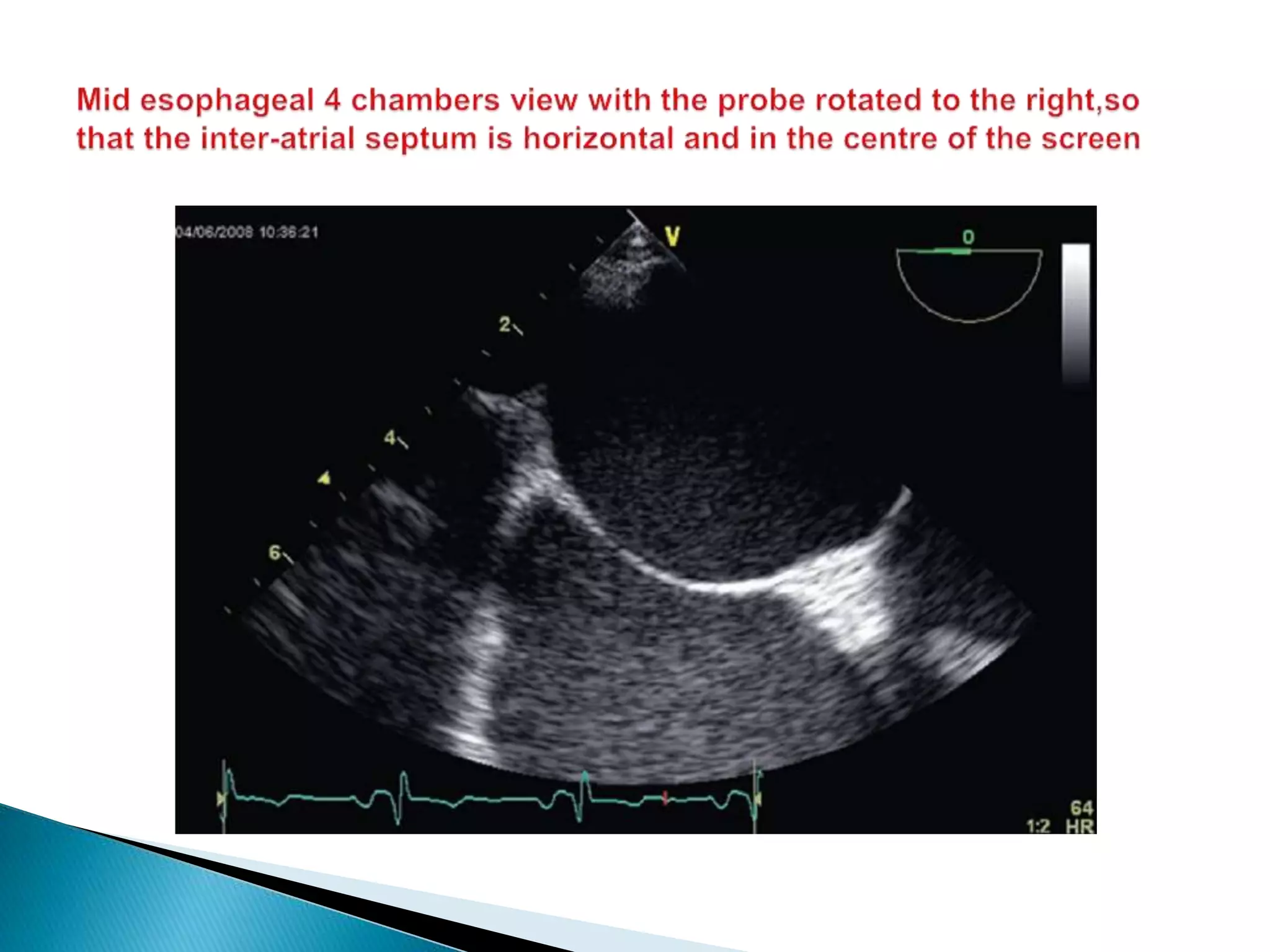 Transesophageal echocardiography(TEE) | PPTX