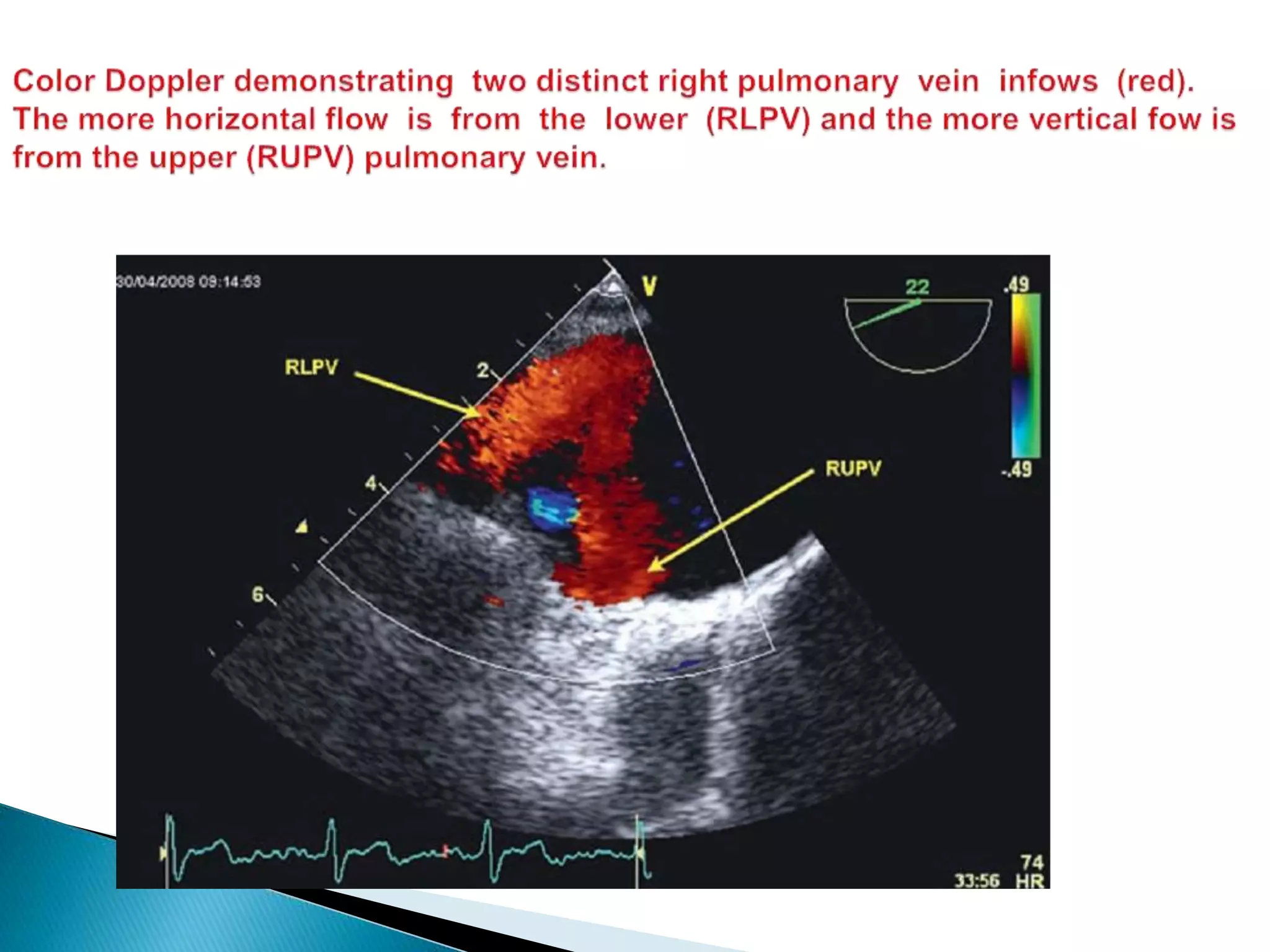 Transesophageal echocardiography(TEE) | PPTX