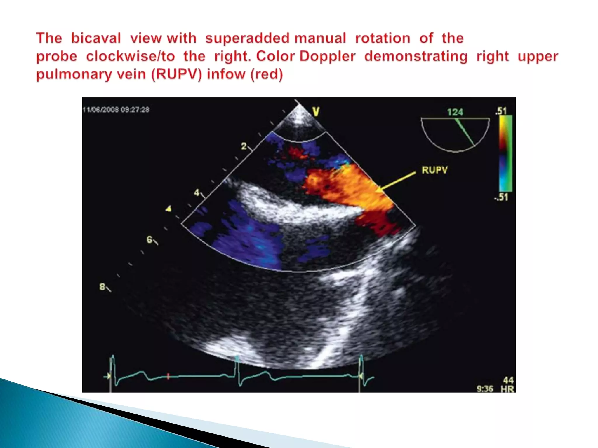 Transesophageal echocardiography(TEE) | PPTX