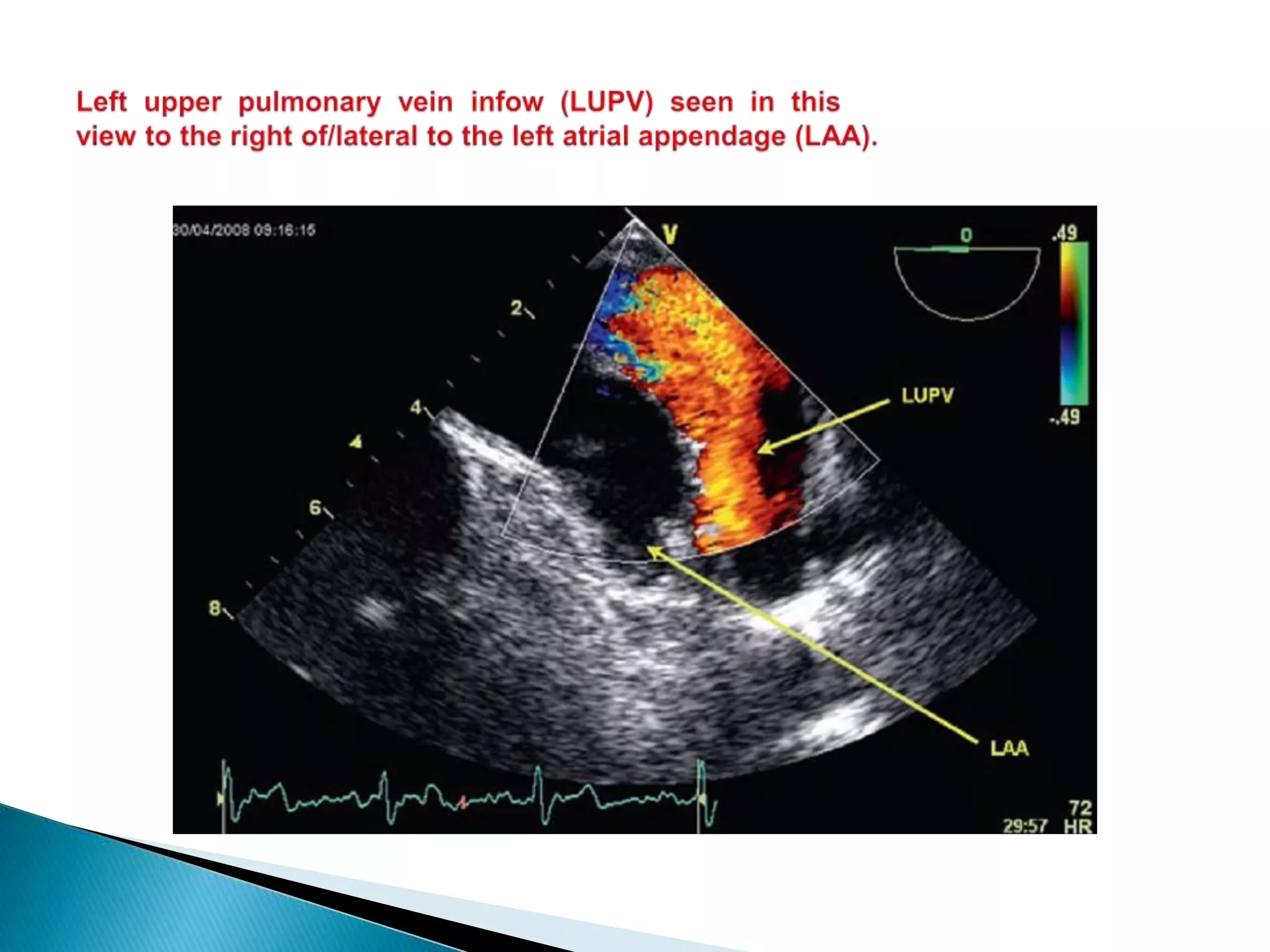 Transesophageal echocardiography(TEE) | PPTX