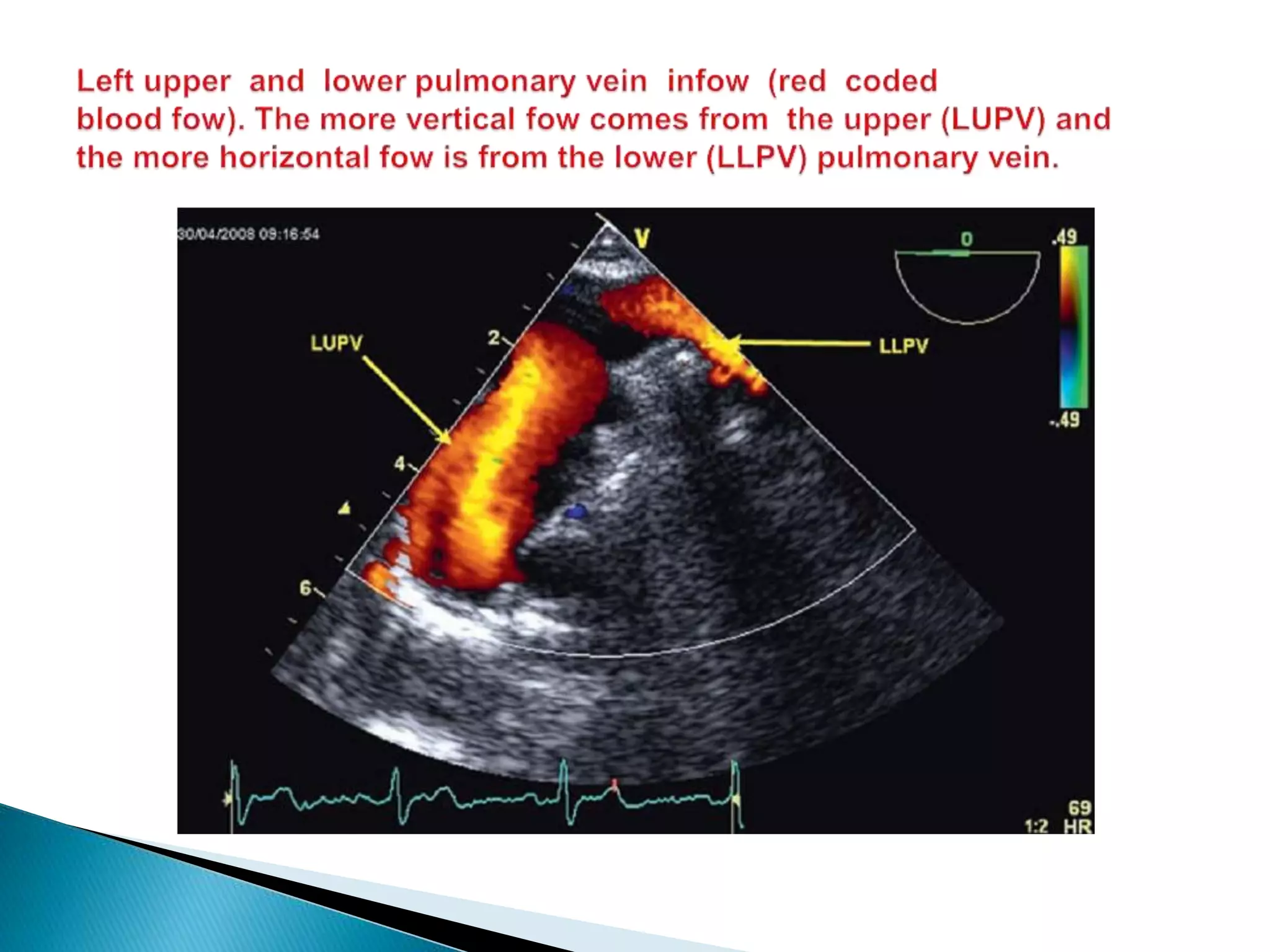 Transesophageal echocardiography(TEE) | PPTX