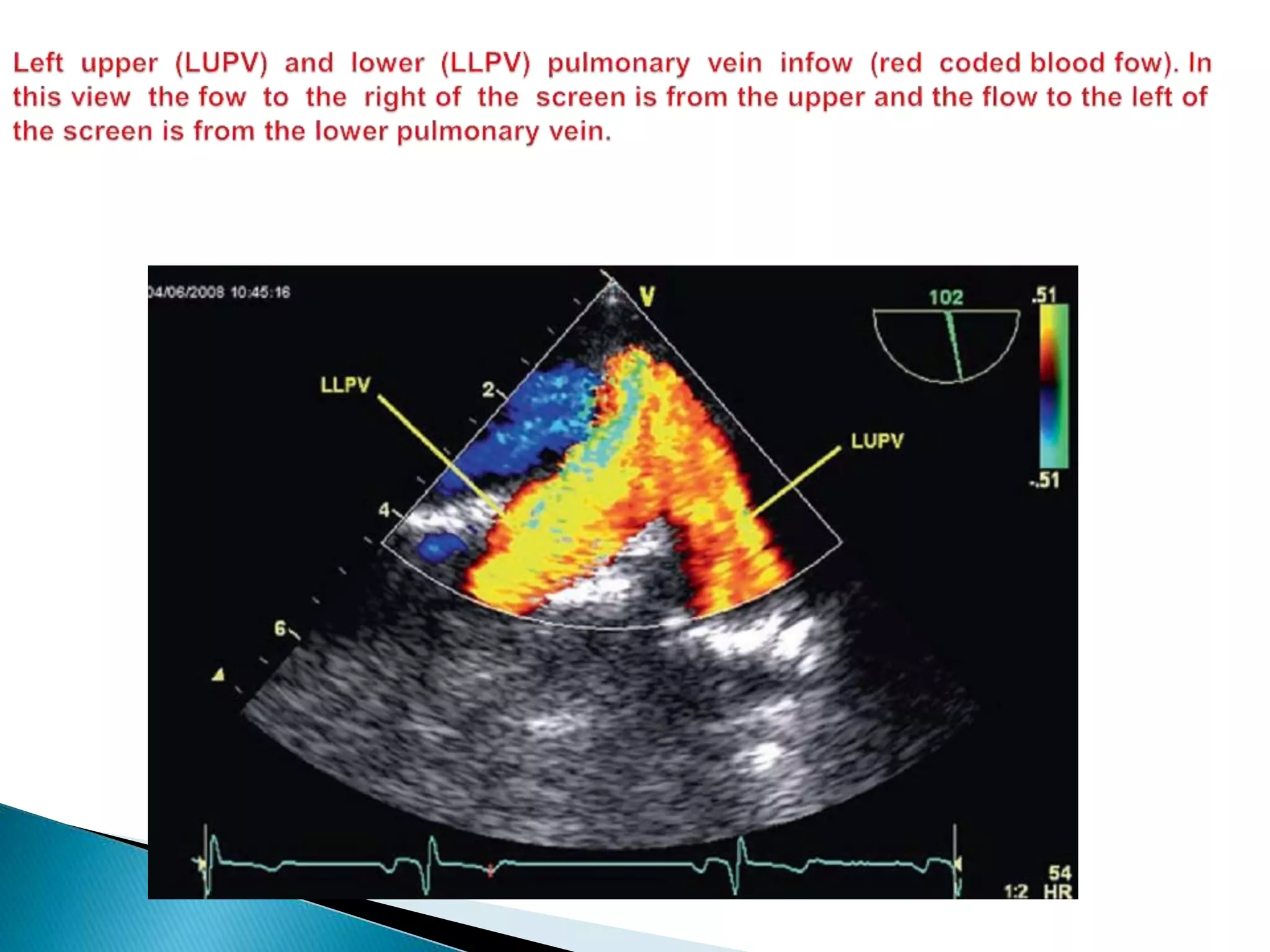 Transesophageal echocardiography(TEE) | PPTX