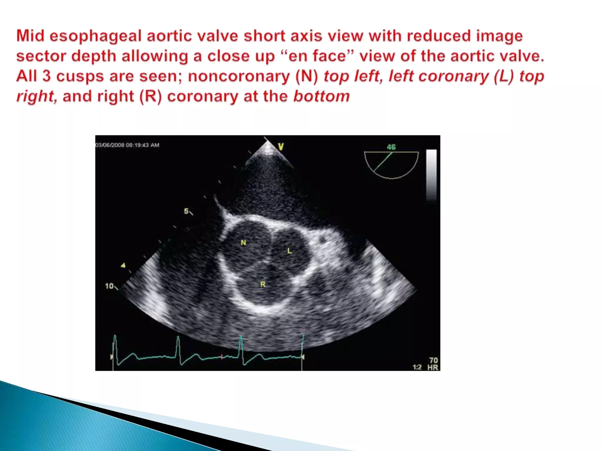 Transesophageal echocardiography(TEE) | PPTX