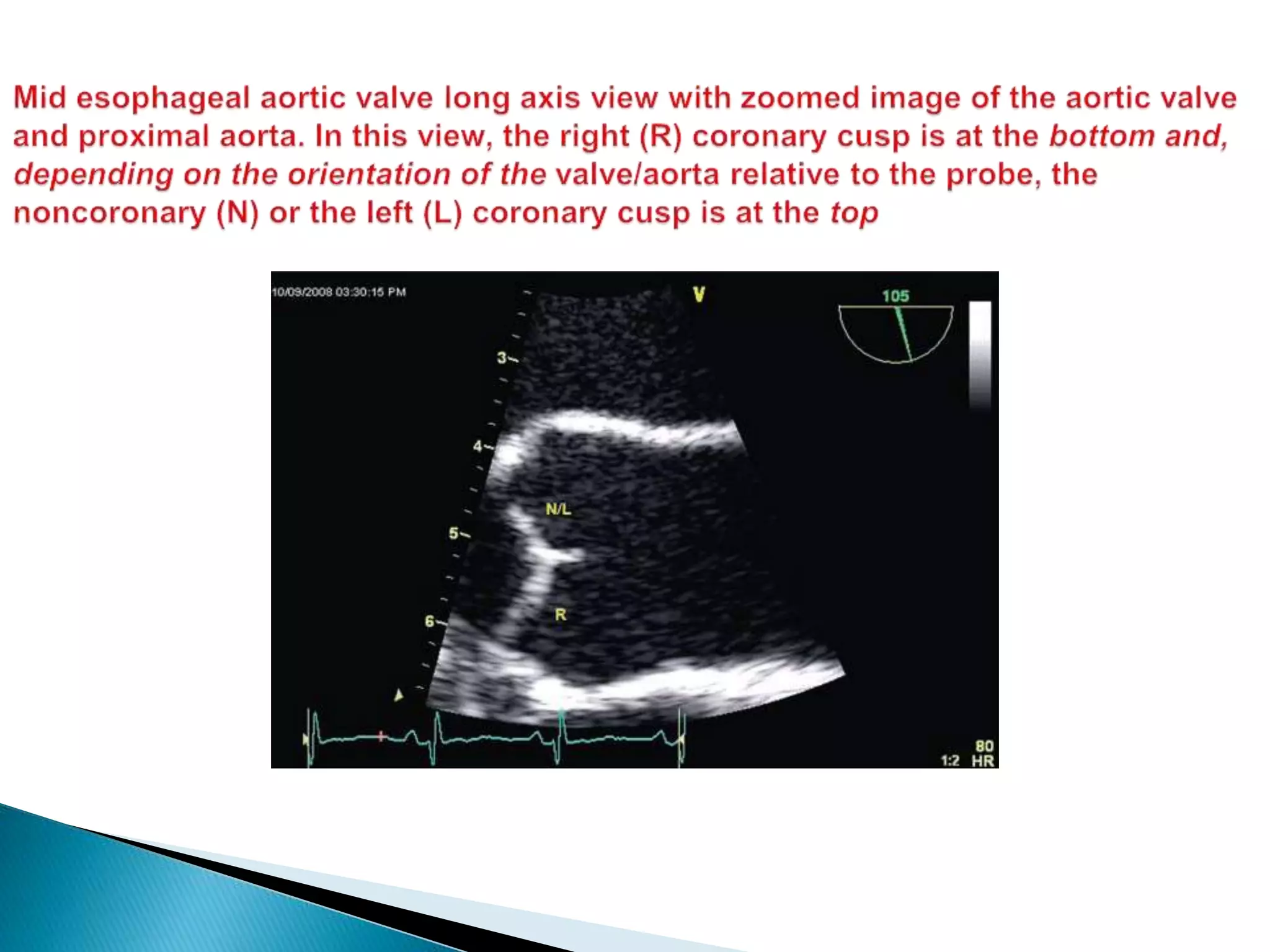 Transesophageal echocardiography(TEE) | PPTX