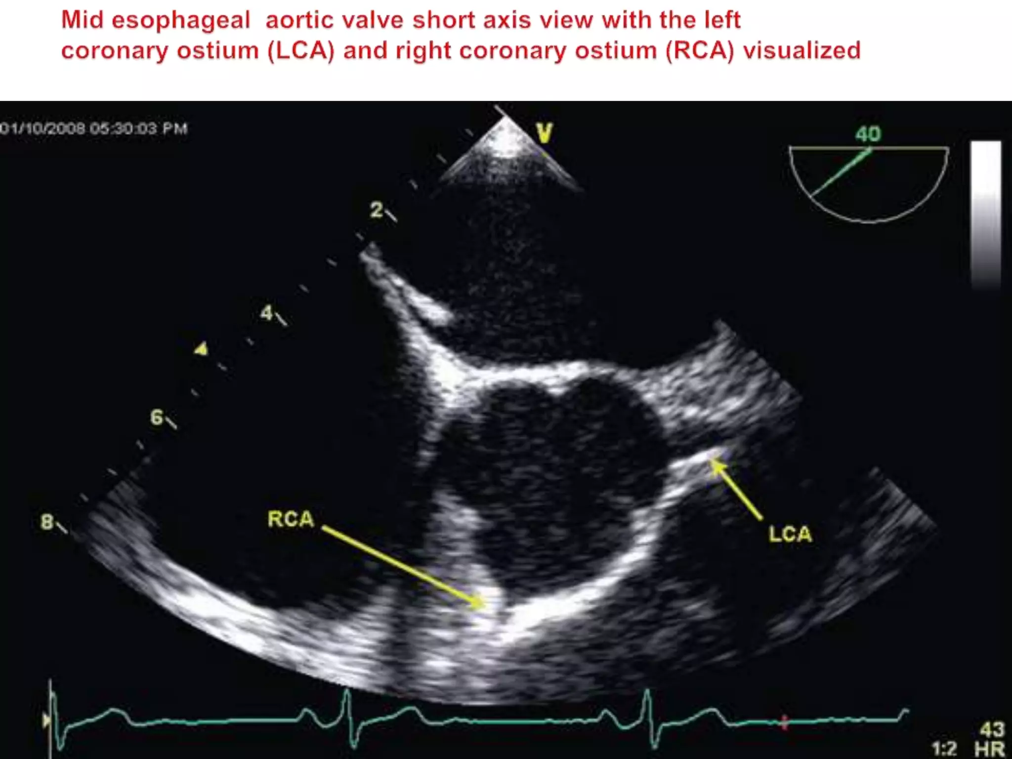 Transesophageal echocardiography(TEE) | PPTX