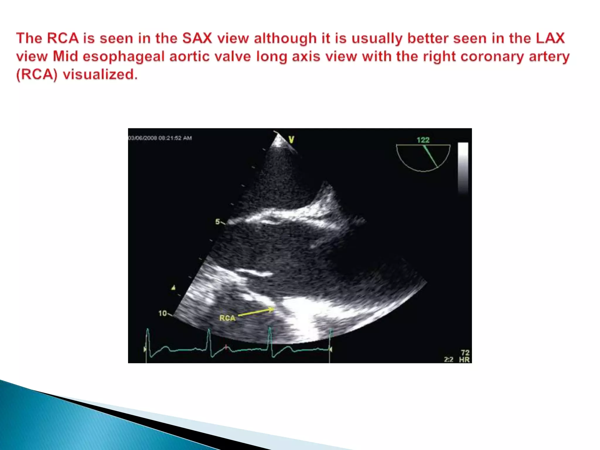 Transesophageal echocardiography(TEE) | PPTX
