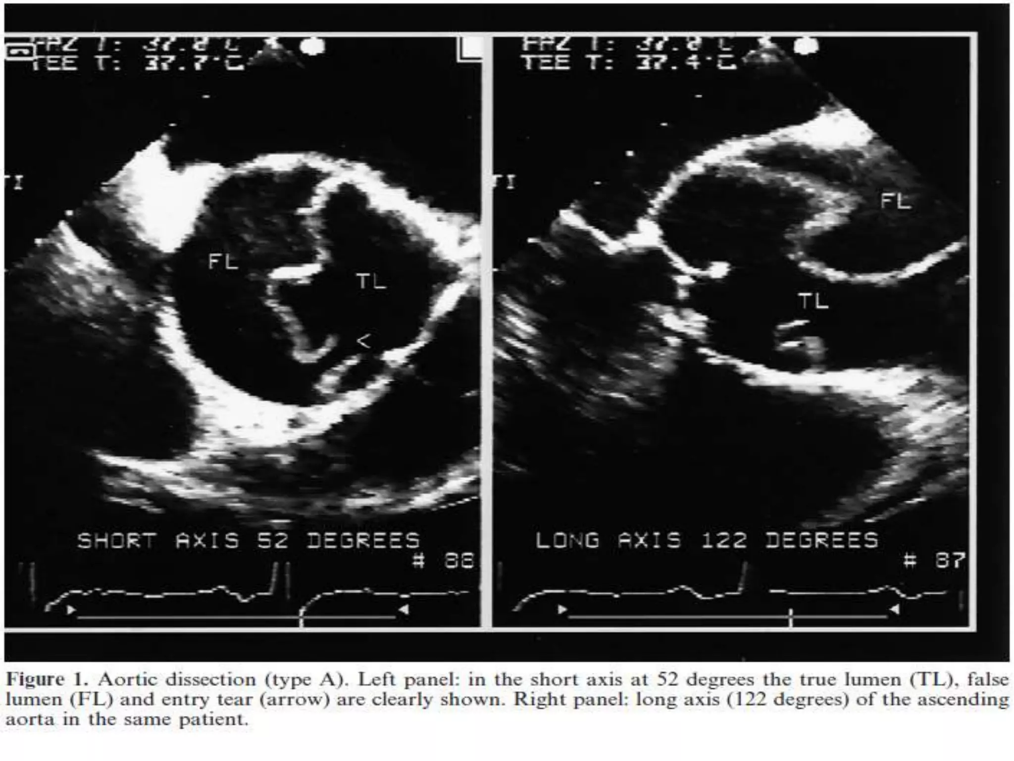 Transesophageal echocardiography(TEE) | PPTX