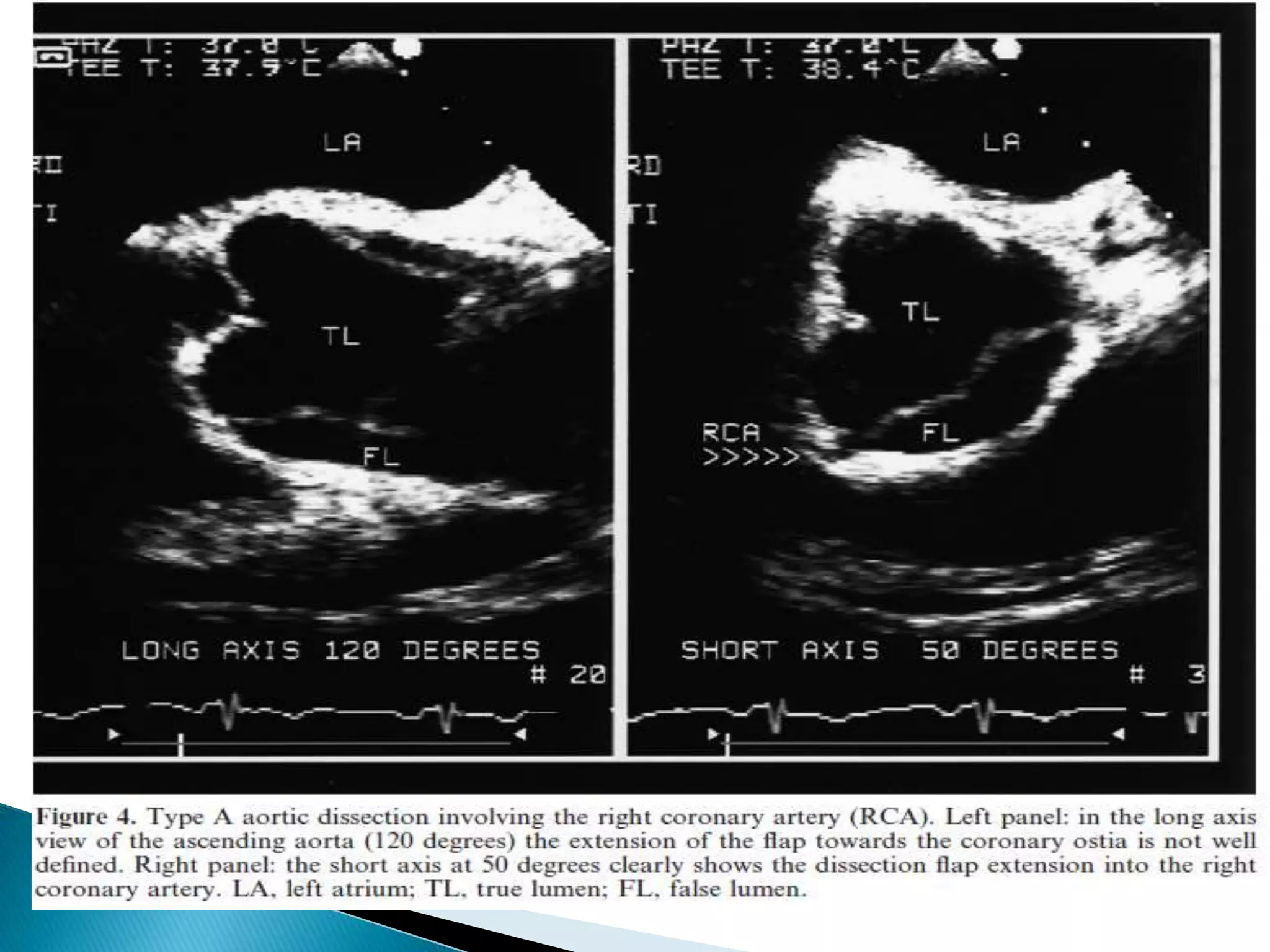Transesophageal echocardiography(TEE) | PPTX
