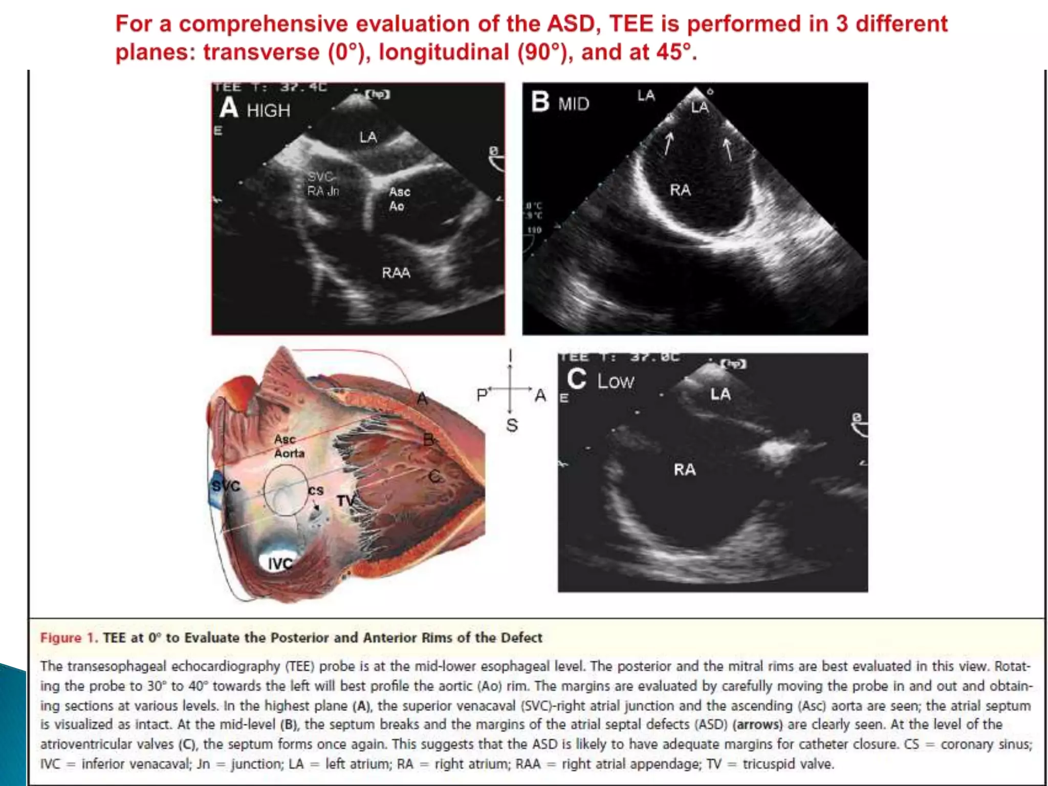 Transesophageal echocardiography(TEE) | PPTX