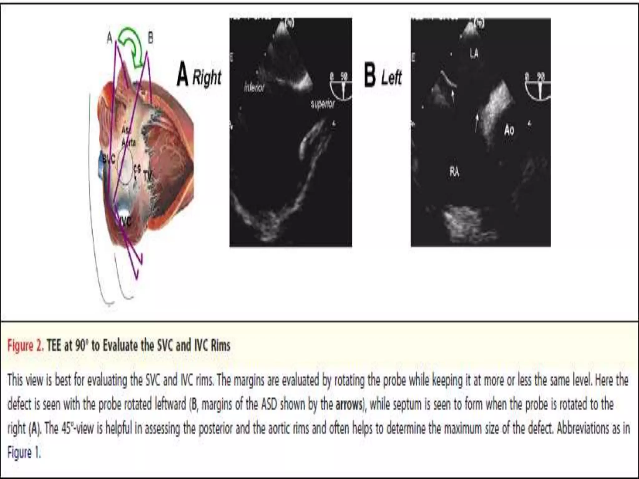 Transesophageal echocardiography(TEE) | PPTX