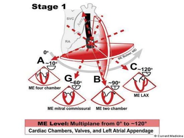 Transesophageal echocardiography(TEE) | PPTX